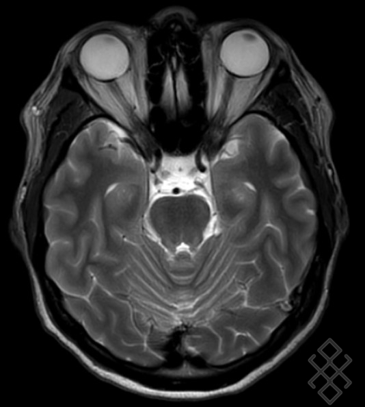 IRM Cérébrale - Définition & Déroulement - Prise de rdv en ligne
