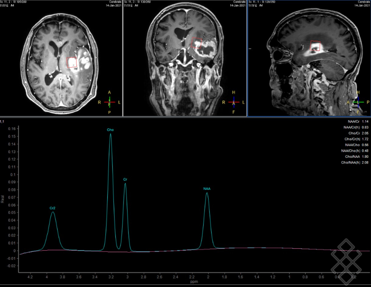 Spectroscopie Cérébrale - Définition & Déroulement - Prise de rdv en ligne