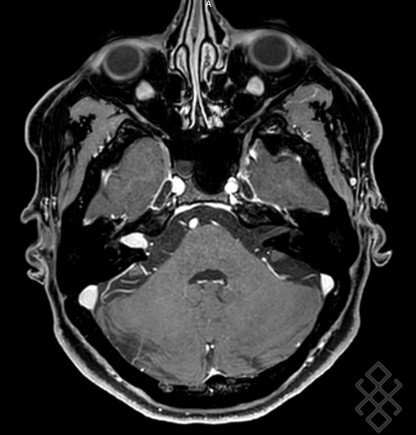 IRM des Conduits Auditifs Internes (CAI) - Définition & Déroulement ...