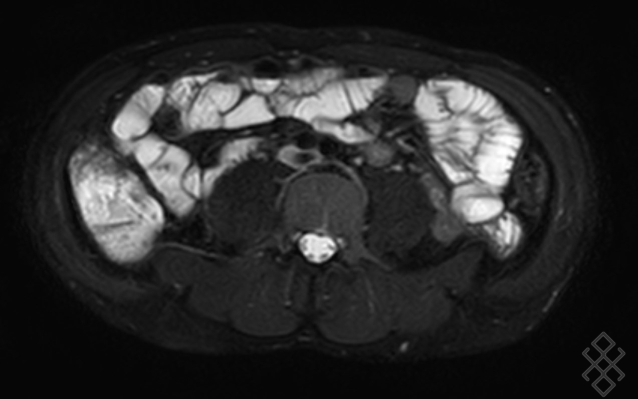 Entéro-IRM - Définition & Déroulement - Prise de rdv en ligne