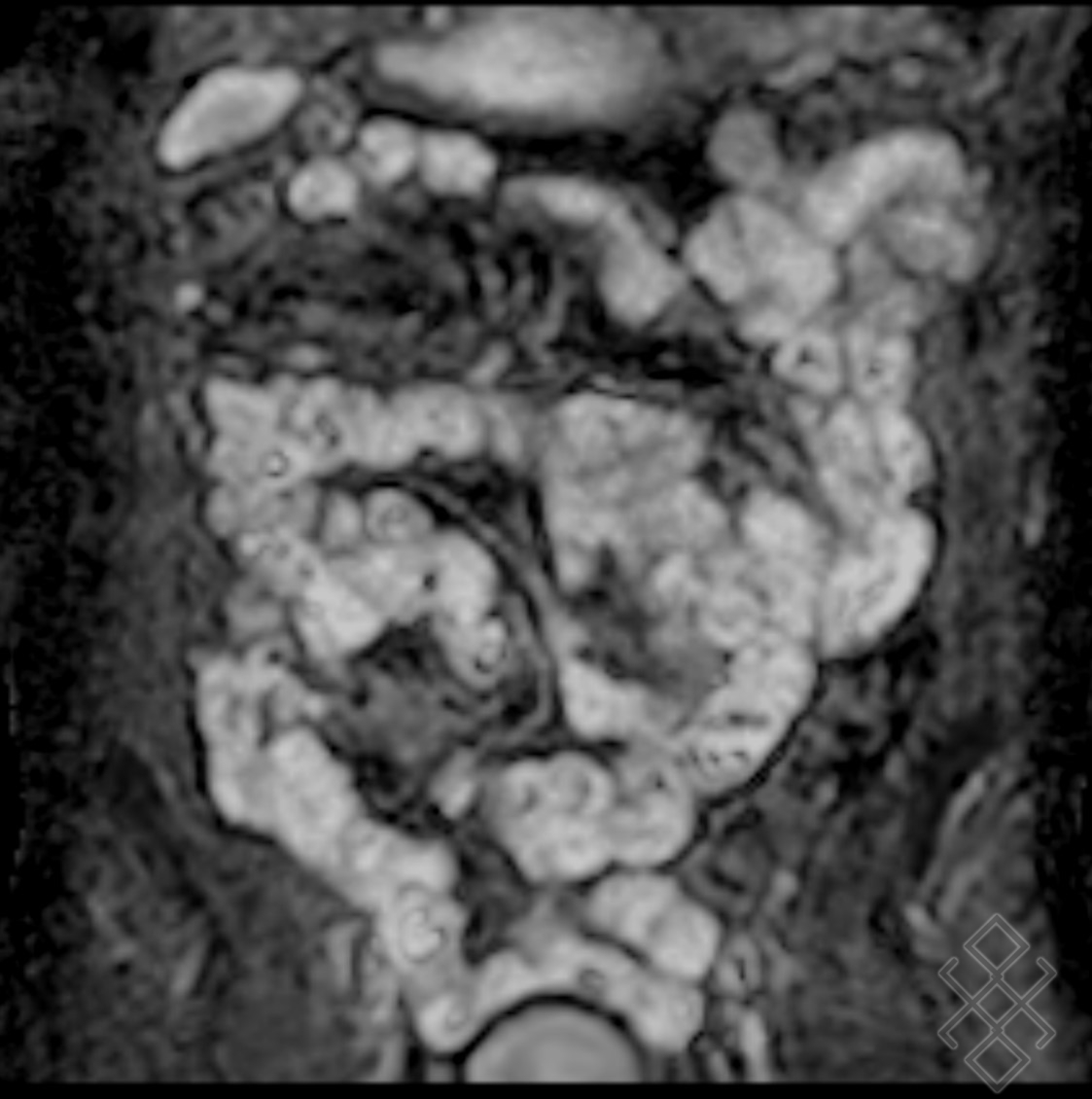Entéro-IRM - Définition & Déroulement - Prise de rdv en ligne