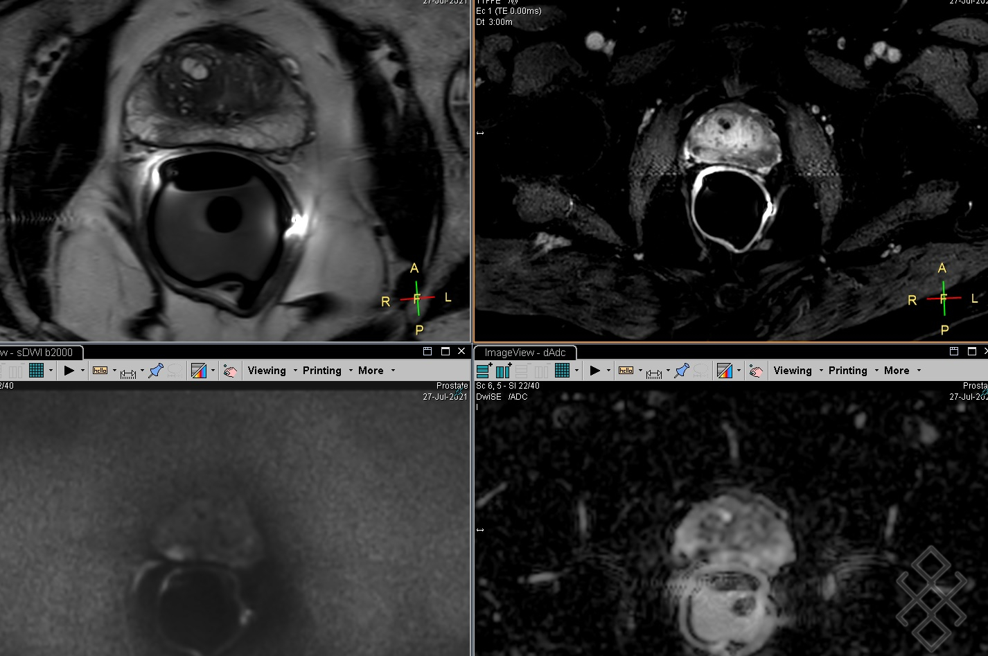 IRM Prostatique - Définition & Déroulement - Prise de rdv en ligne