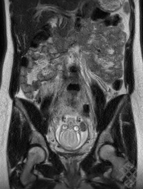 IRM Pelvienne - Définition & Déroulement - Prise de rdv en ligne