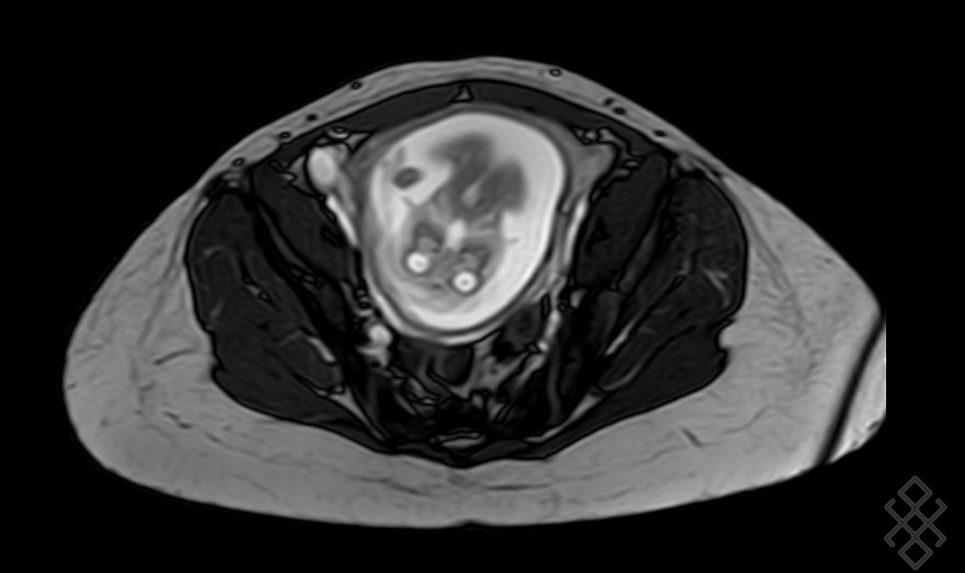 IRM Pelvienne - Définition & Déroulement - Prise de rdv en ligne