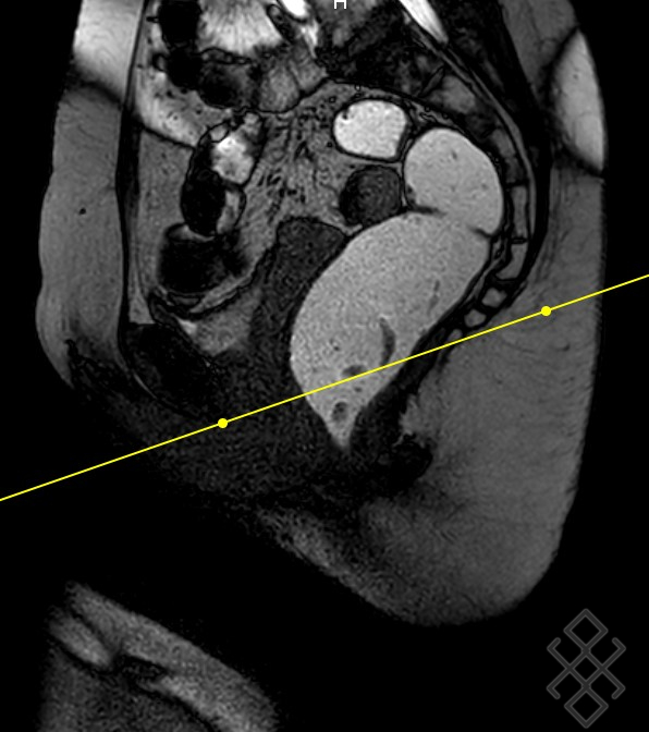 IRM du Rectum - Définition & Déroulement - Prise de rdv en ligne