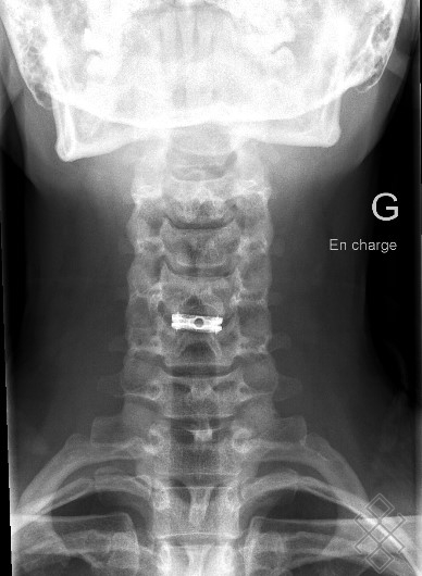 Radiographie du Rachis cervical - Définition & Déroulement - Prise de ...