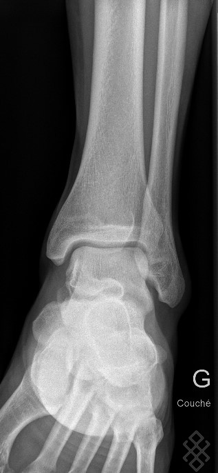 Radiographie de la Cheville - Définition & Déroulement - Prise de rdv ...