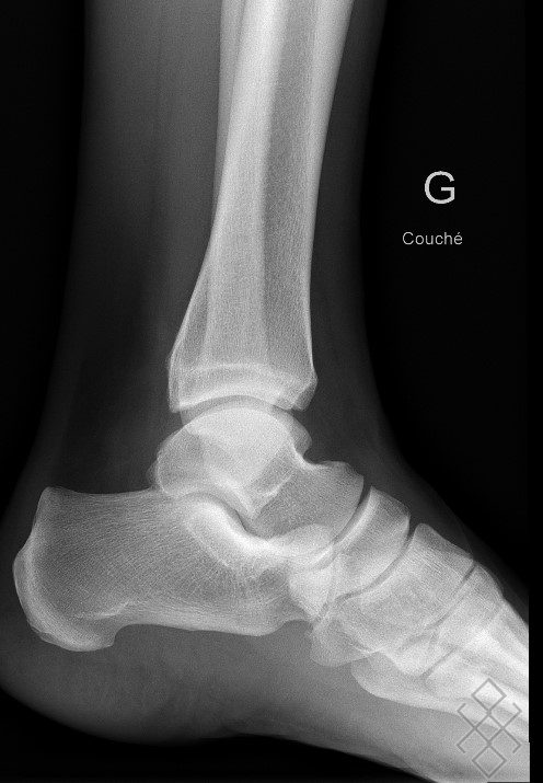 Radiographie de la Cheville - Définition & Déroulement - Prise de rdv ...