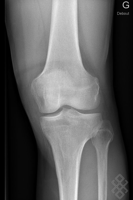 Radiographie du Genou - Définition & Déroulement - Prise de rdv en ligne