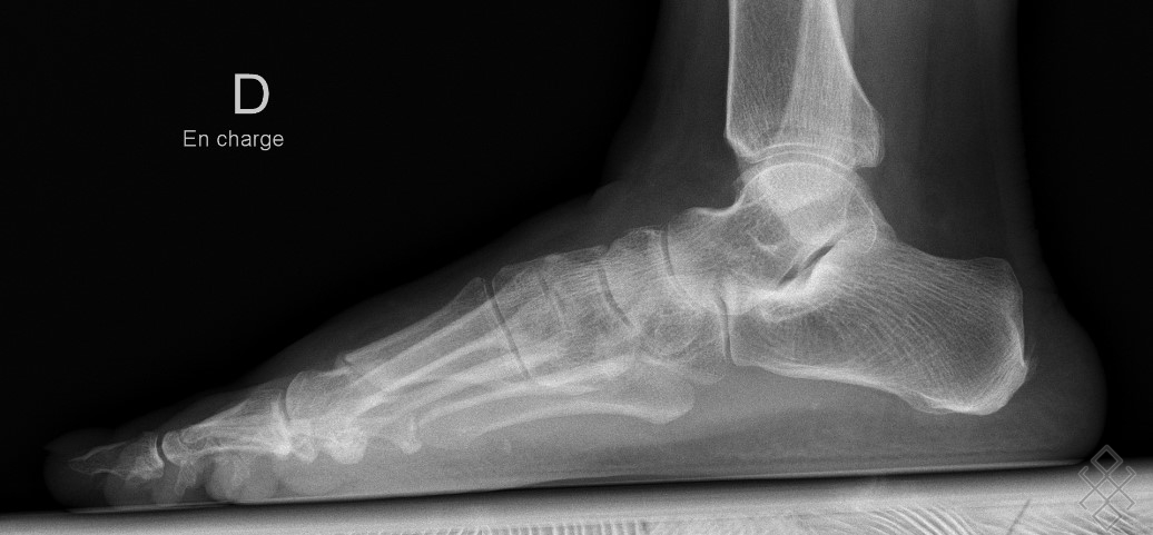 Radiographie du Pied - Définition & Déroulement - Prise de rdv en ligne