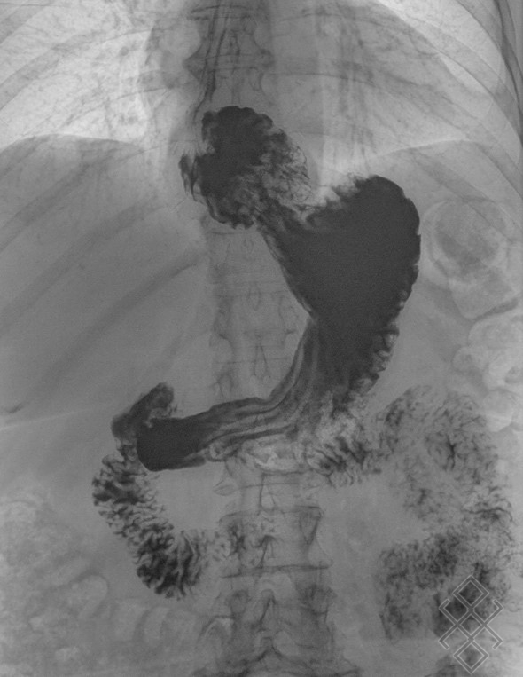 Transit Oeso-Gastro-Duodénal (TOGD) - Définition & Déroulement - Prise ...