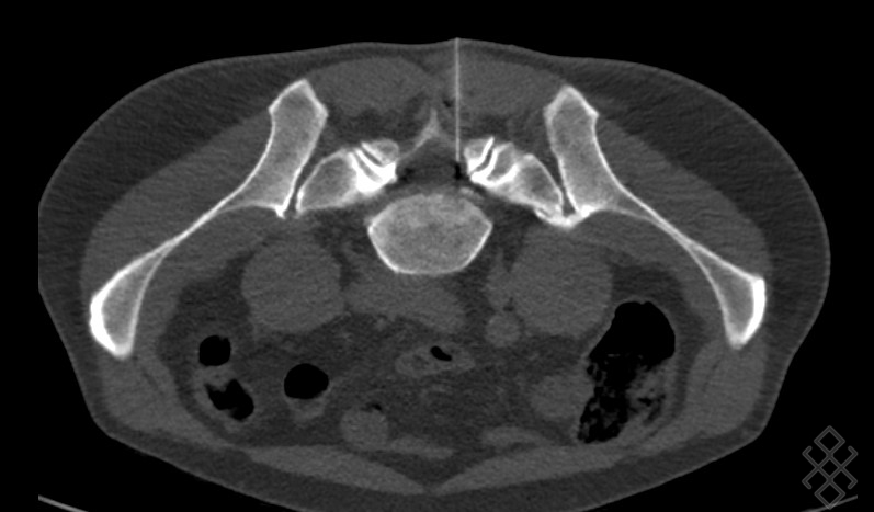 Infiltration Lombaire sous Scanner - Définition & Déroulement - Prise ...