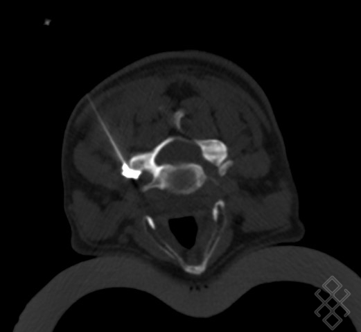Infiltration Cervicale sous Scanner - Définition & Déroulement - Prise ...