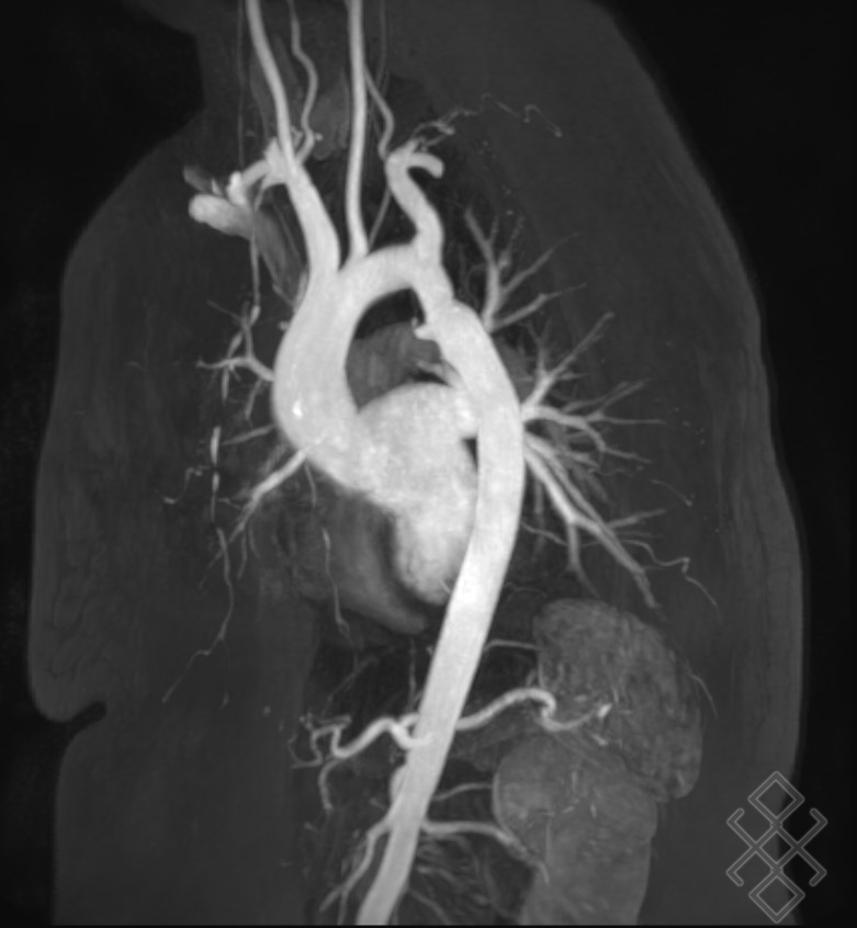 Angio-IRM Thoracique - Définition & Déroulement - Prise de rdv en ligne
