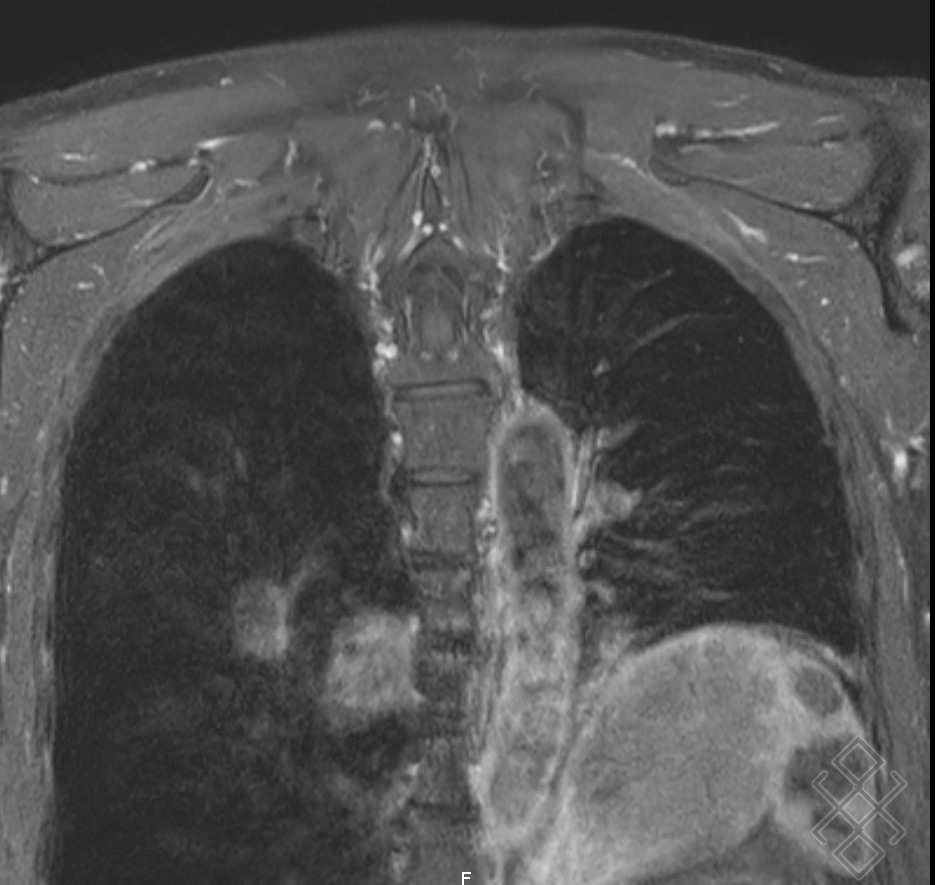 IRM Thoracique - Définition & Déroulement - Prise de rdv en ligne