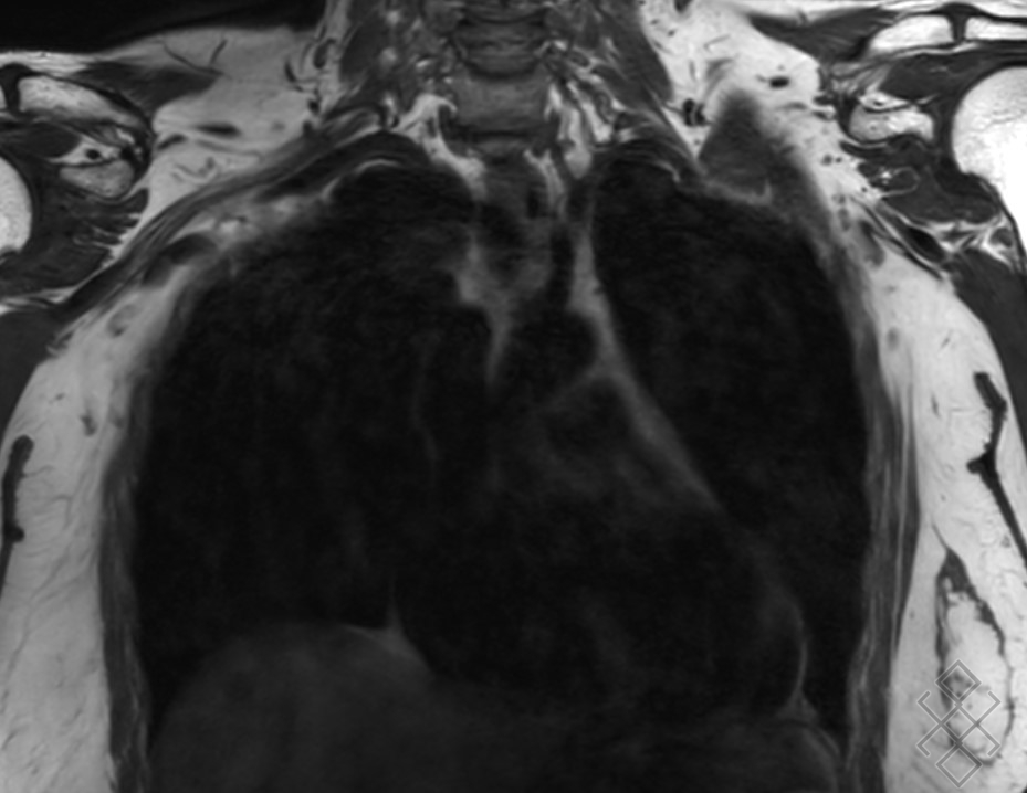 IRM Thoracique - Définition & Déroulement - Prise de rdv en ligne