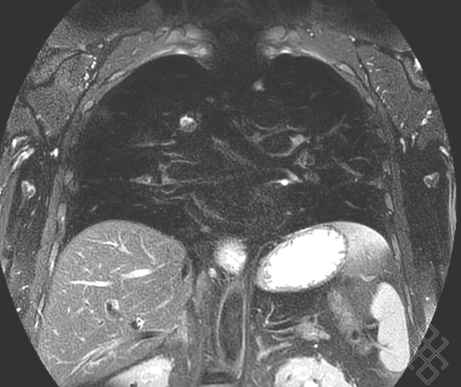 IRM Thoracique - Définition & Déroulement - Prise de rdv en ligne