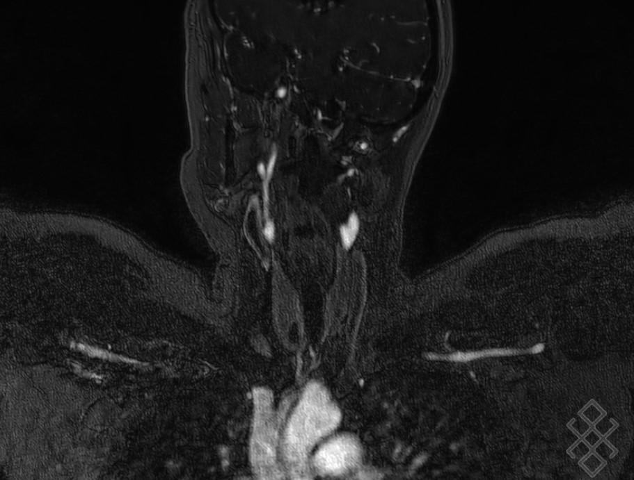 Angio-IRM des Membres supérieurs - Définition & Déroulement - Prise de ...