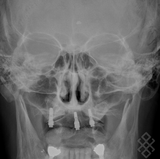 Radiographie des Sinus - Définition & Déroulement - Prise de rdv en ligne