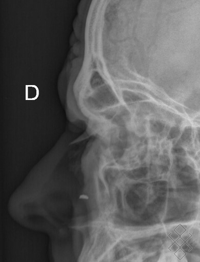 Radiographie des Os Propres du Nez (OPN) - Définition & Déroulement ...