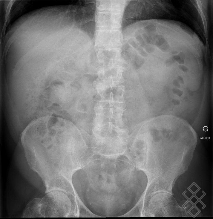Radiographie ASP (Abdomen sans préparation) - Définition & Déroulement ...