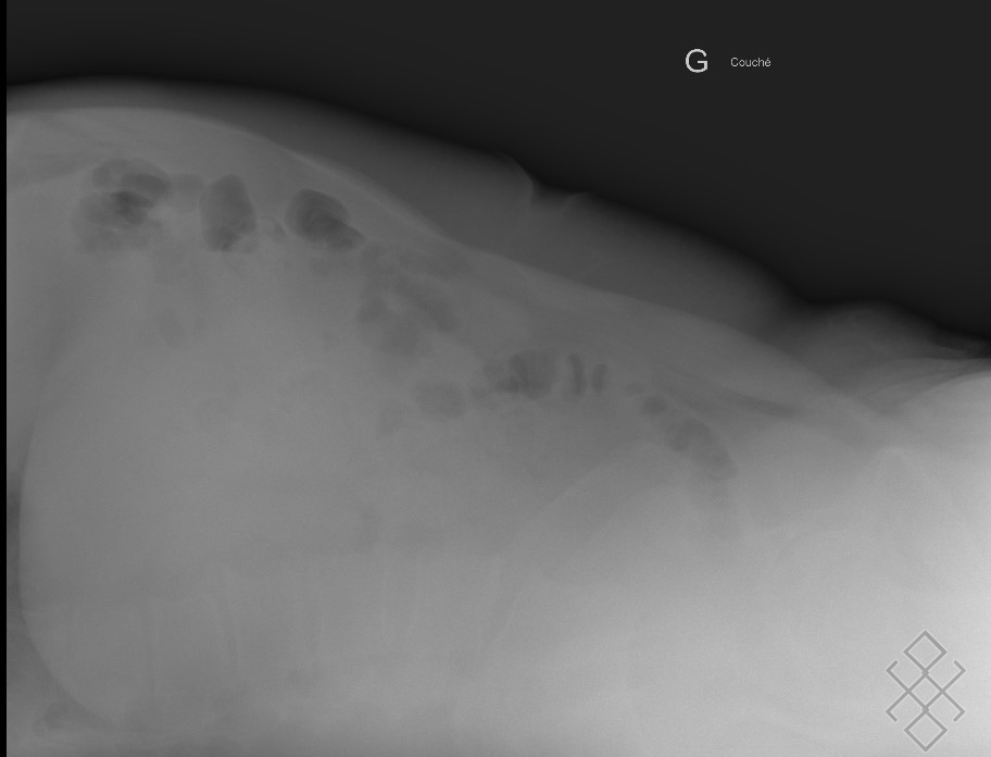 Radiographie ASP (Abdomen sans préparation) - Définition & Déroulement ...