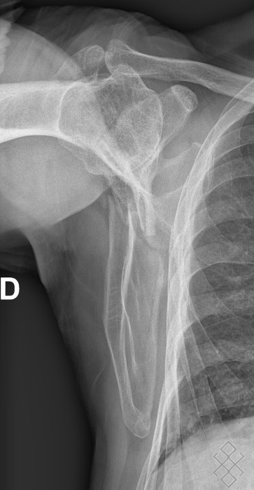 Radiographie de l’Omoplate - Définition & Déroulement - Prise de rdv en ...