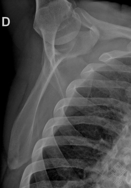 Radiographie de l’Omoplate - Définition & Déroulement - Prise de rdv en ...