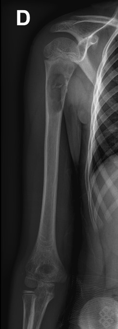 Radiographie du Bras (humérus) - Définition & Déroulement - Prise de ...