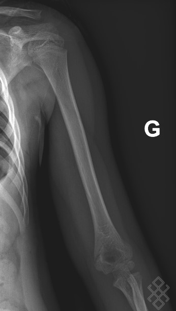 Radiographie du Bras (humérus) - Définition & Déroulement - Prise de ...