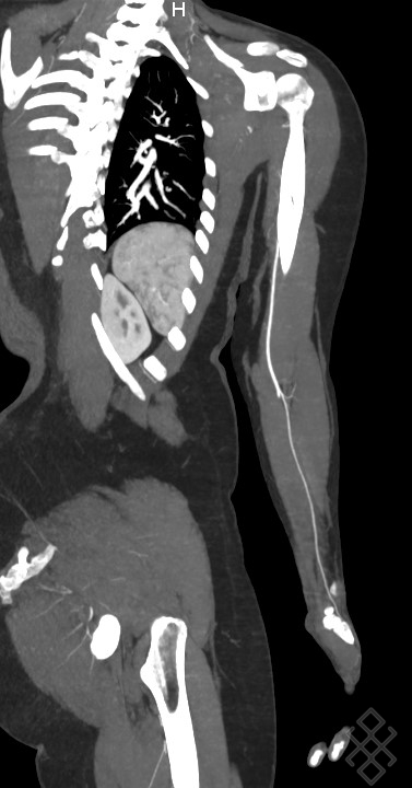 Angioscanner des Membres supérieurs - Définition & Déroulement - Prise ...