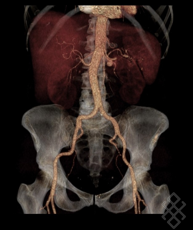 Angioscanner Abdominal - Définition & Déroulement - Prise de rdv en ligne