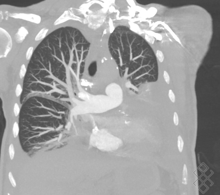 Angioscanner Thoracique - Définition & Déroulement - Prise de rdv en ligne