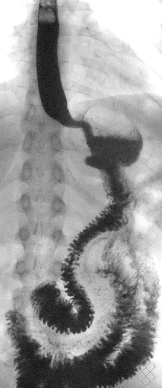Transit Oeso-Gastro-Duodénal (TOGD) - Définition & Déroulement - Prise ...