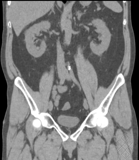 Uroscanner - Définition & Déroulement - Prise de rdv en ligne