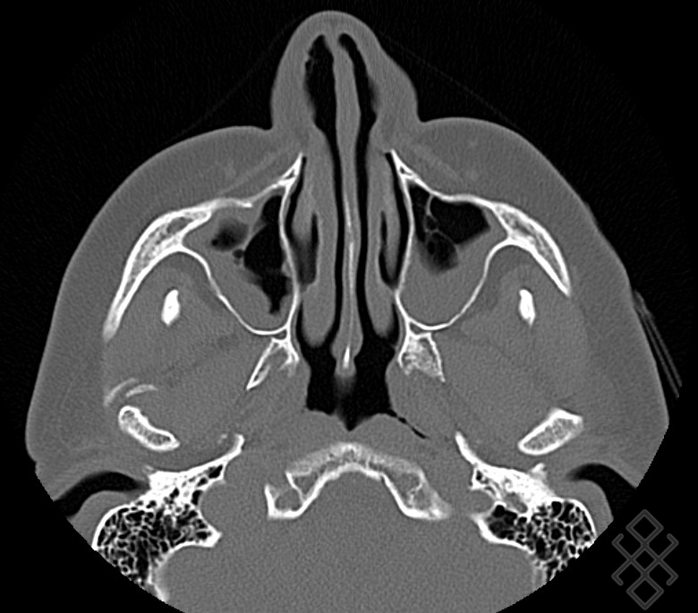 Scanner des Sinus - Définition & Déroulement - Prise de rdv en ligne