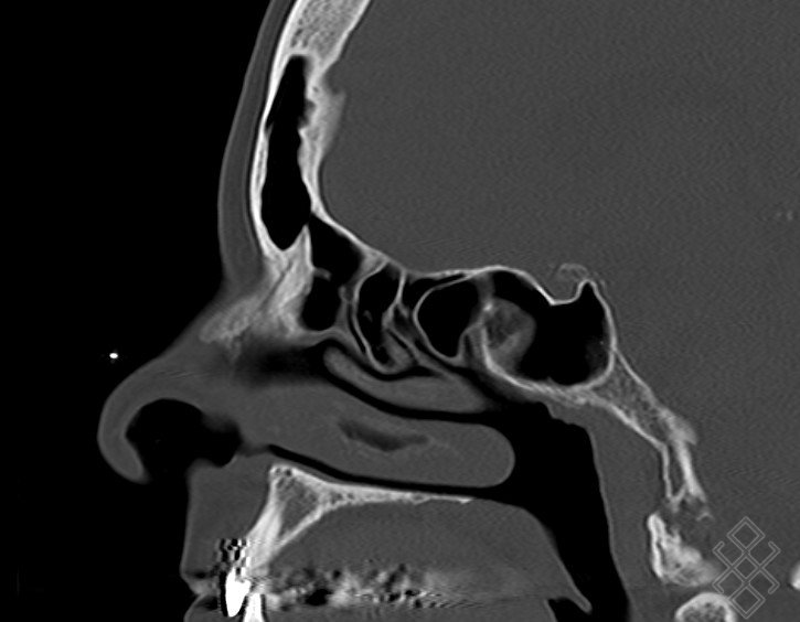 Scanner des Sinus - Définition & Déroulement - Prise de rdv en ligne