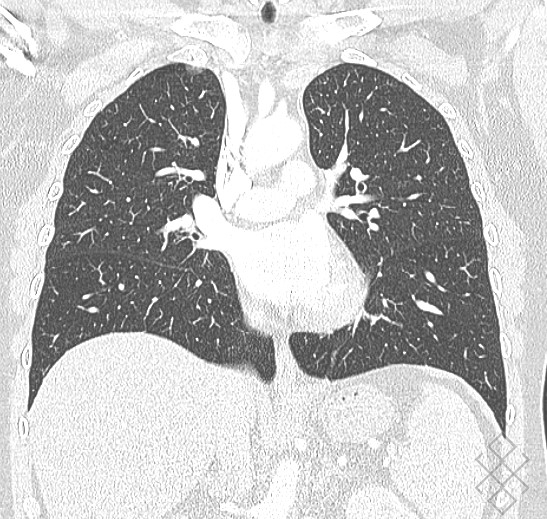 Scanner Thoracique - Définition & Déroulement - Prise de rdv en ligne
