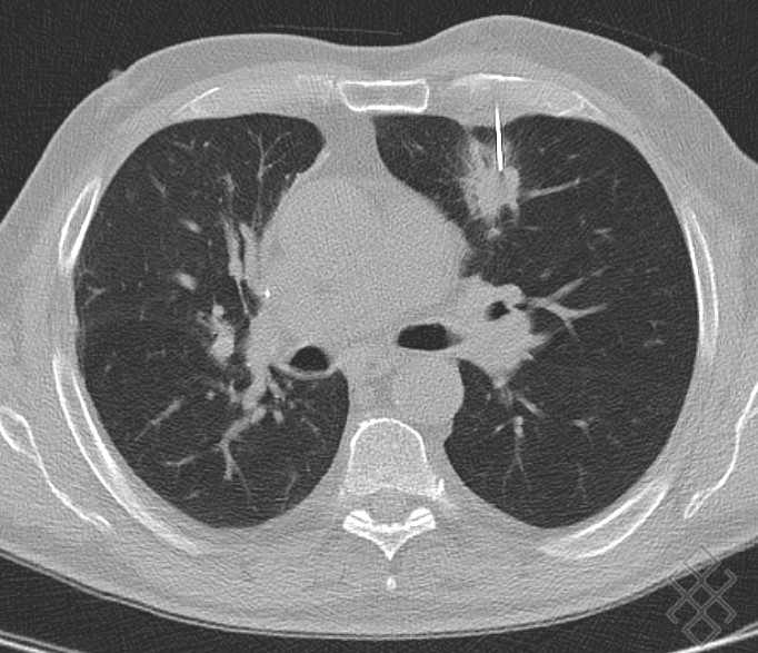 Scanner Thoracique - Définition & Déroulement - Prise de rdv en ligne