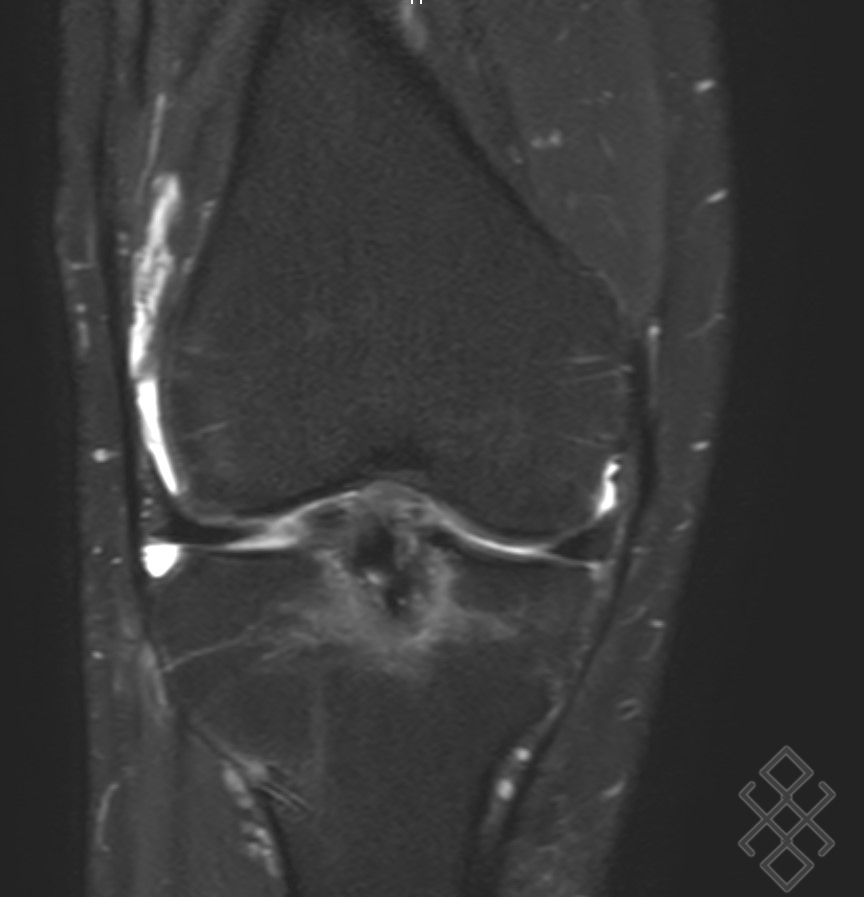 Arthro-IRM du Genou - Définition & Déroulement - Prise de rdv en ligne