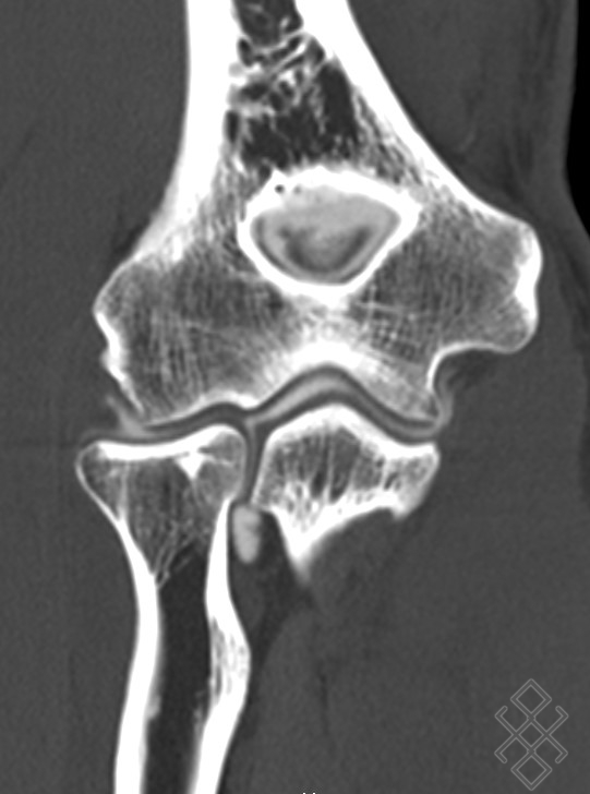 Arthroscanner du Coude - Définition & Déroulement - Prise de rdv en ligne