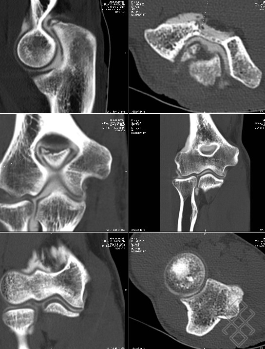 Arthroscanner du Coude - Définition & Déroulement - Prise de rdv en ligne