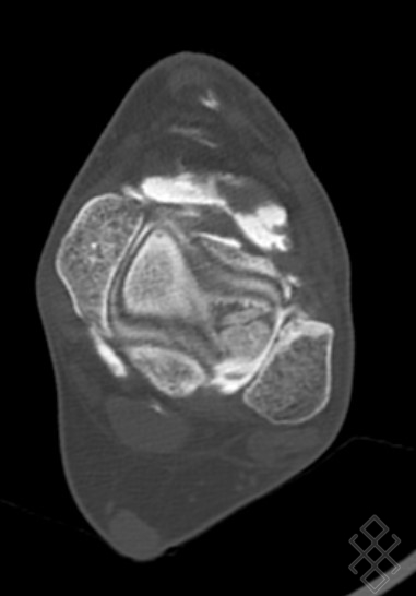 Arthroscanner de la Cheville - Définition & Déroulement - Prise de rdv ...