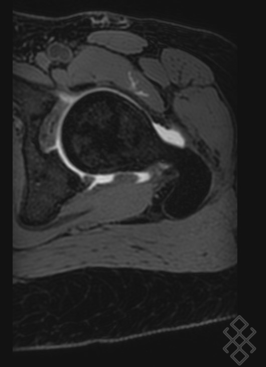 Arthro-IRM de la Hanche - Définition & Déroulement - Prise de rdv en ligne