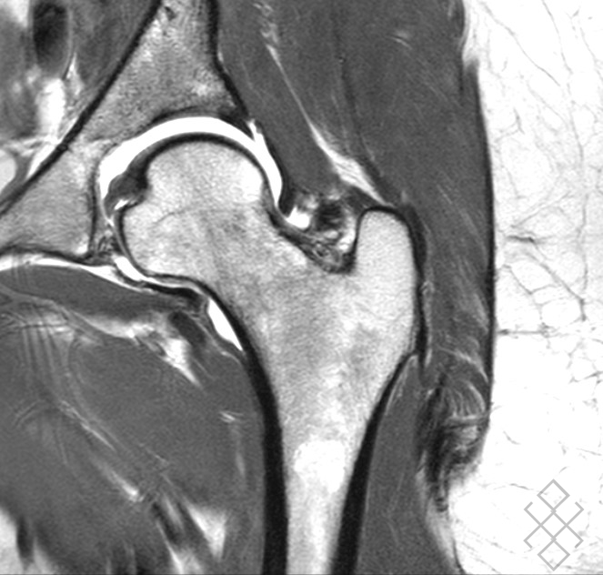 Arthro-IRM de la Hanche - Définition & Déroulement - Prise de rdv en ligne