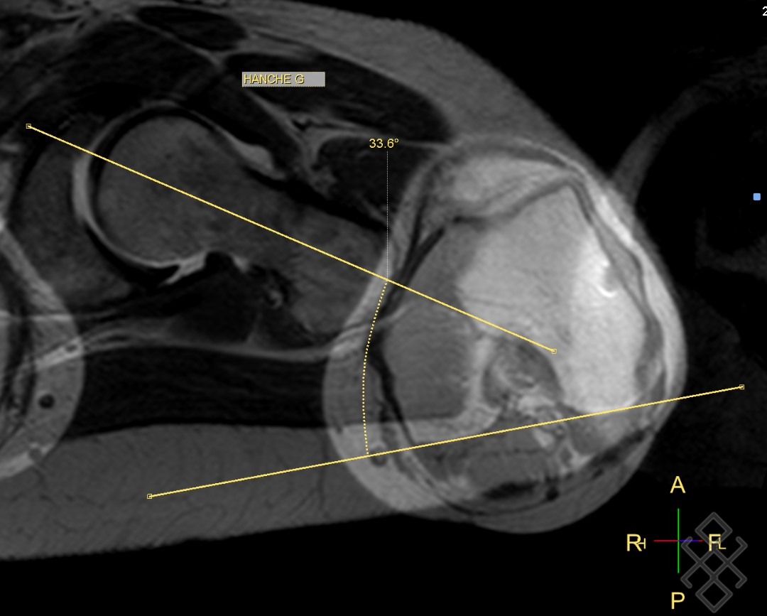 Arthro-IRM de la Hanche - Définition & Déroulement - Prise de rdv en ligne