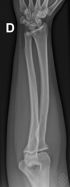 Radiographie de l’Avant-bras (radius, cubitus) - Définition ...
