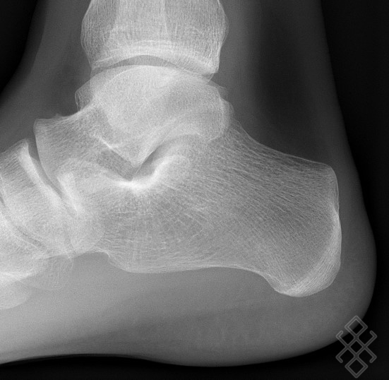 Radiographie du Talon - Définition & Déroulement - Prise de rdv en ligne