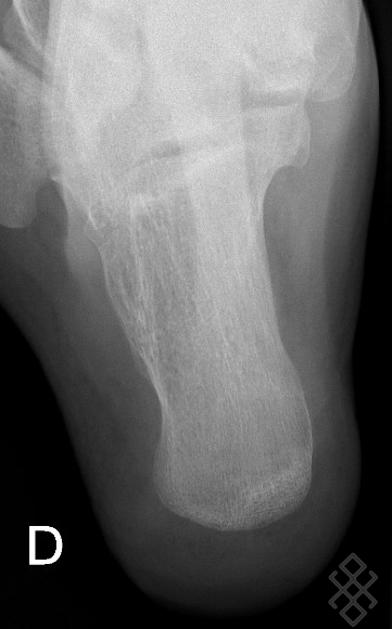 Radiographie du Talon - Définition & Déroulement - Prise de rdv en ligne