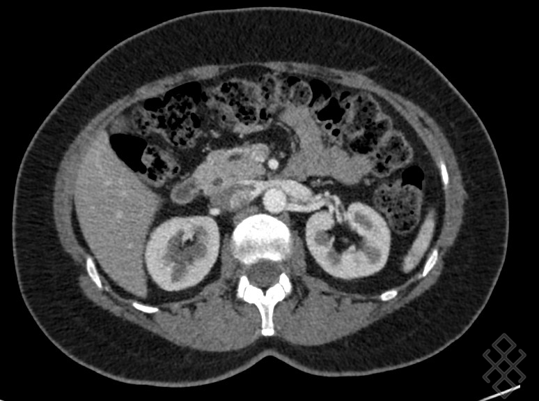 Uroscanner - Définition & Déroulement - Prise de rdv en ligne